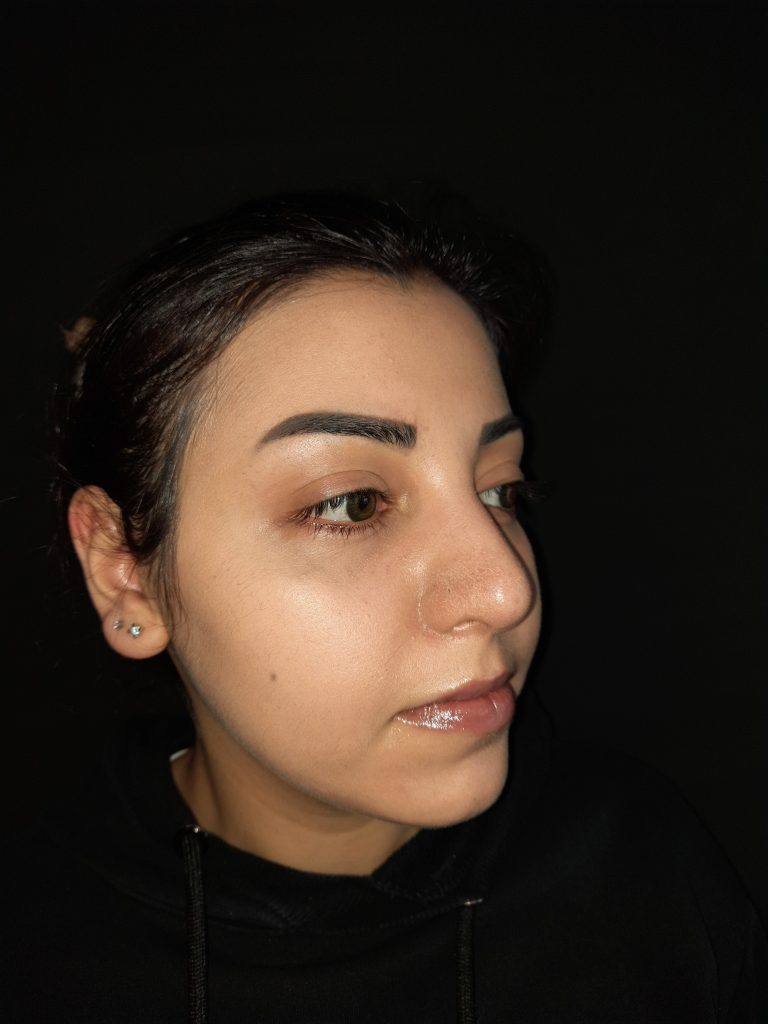 Rhinoplasty in London | Dr. Mesut Dogan ENT Specialist